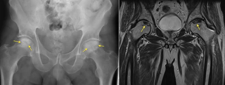 Best Non Invasive AVN Avascular Necrosis Treatment in Rajkot - Blessed ...